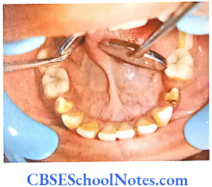 Genetics Of Developmental Disorders Of Teeth Notes - CBSE School Notes