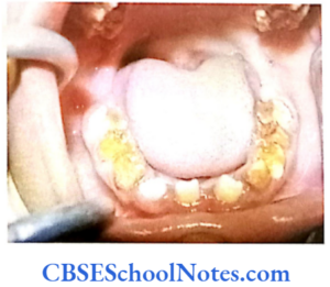 Genetics Of Developmental Disorders Of Teeth Notes - CBSE School Notes