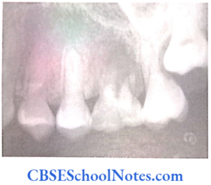 Genetics Of Developmental Disorders Of Teeth Notes - CBSE School Notes