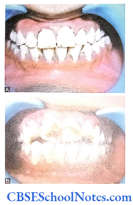 Genetics Of Developmental Disorders Of Teeth Notes - CBSE School Notes