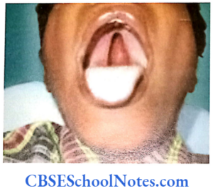 Genetics Of Cleft Lip And Cleft Palate Notes - CBSE School Notes