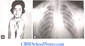 Genetics Of Craniofacial Disorders And Syndromes Notes - CBSE School Notes