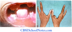 Genetics Of Craniofacial Disorders And Syndromes Notes - CBSE School Notes