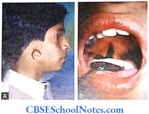 Genetics Of Craniofacial Disorders And Syndromes Notes - CBSE School Notes