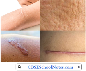Acute And Chronic Inflammation Notes - CBSE School Notes